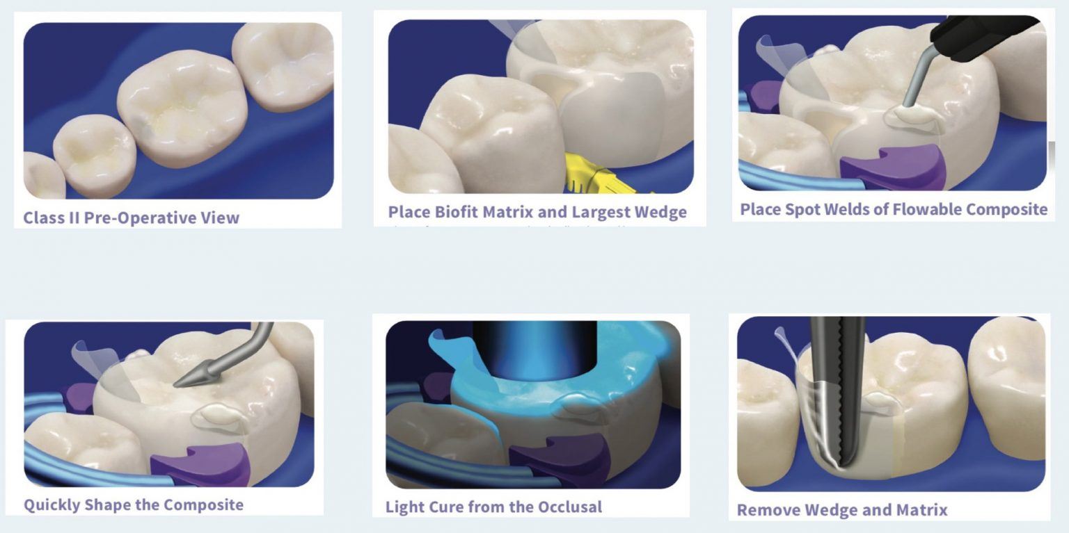 Bioclear® Method - Whitemarsh Family Dentistry