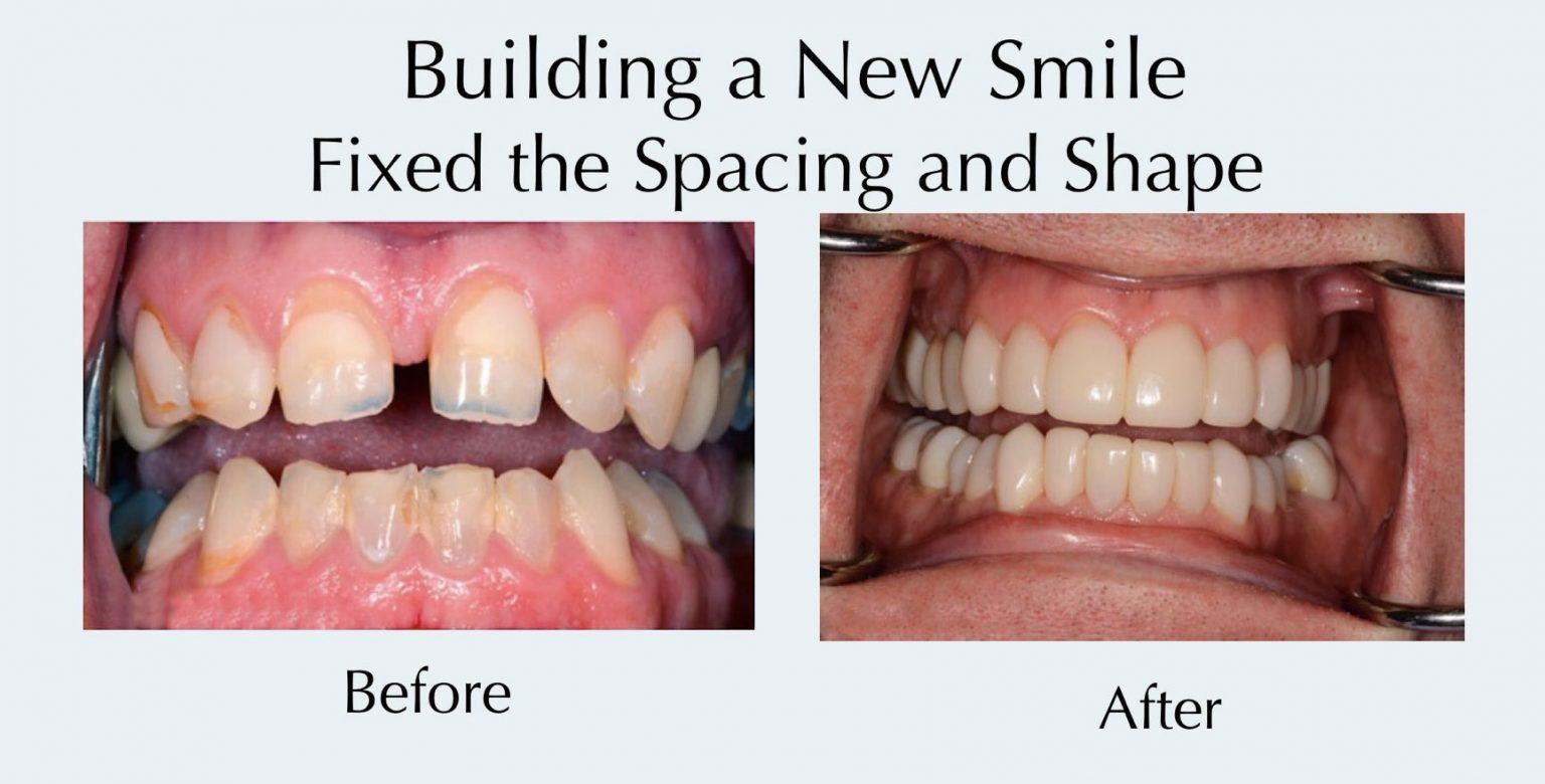 Bioclear® Method - Whitemarsh Family Dentistry