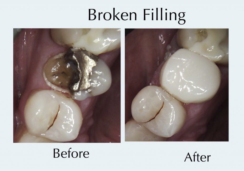 Bioclear® Method - Whitemarsh Family Dentistry