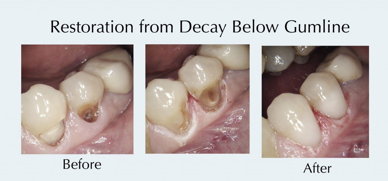 Bioclear® Method - Whitemarsh Family Dentistry